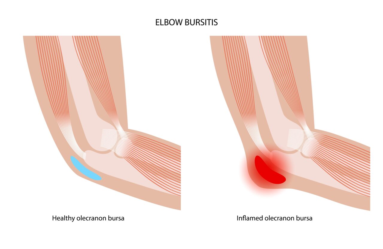 Bursitis de codo: Todo lo que debes saber