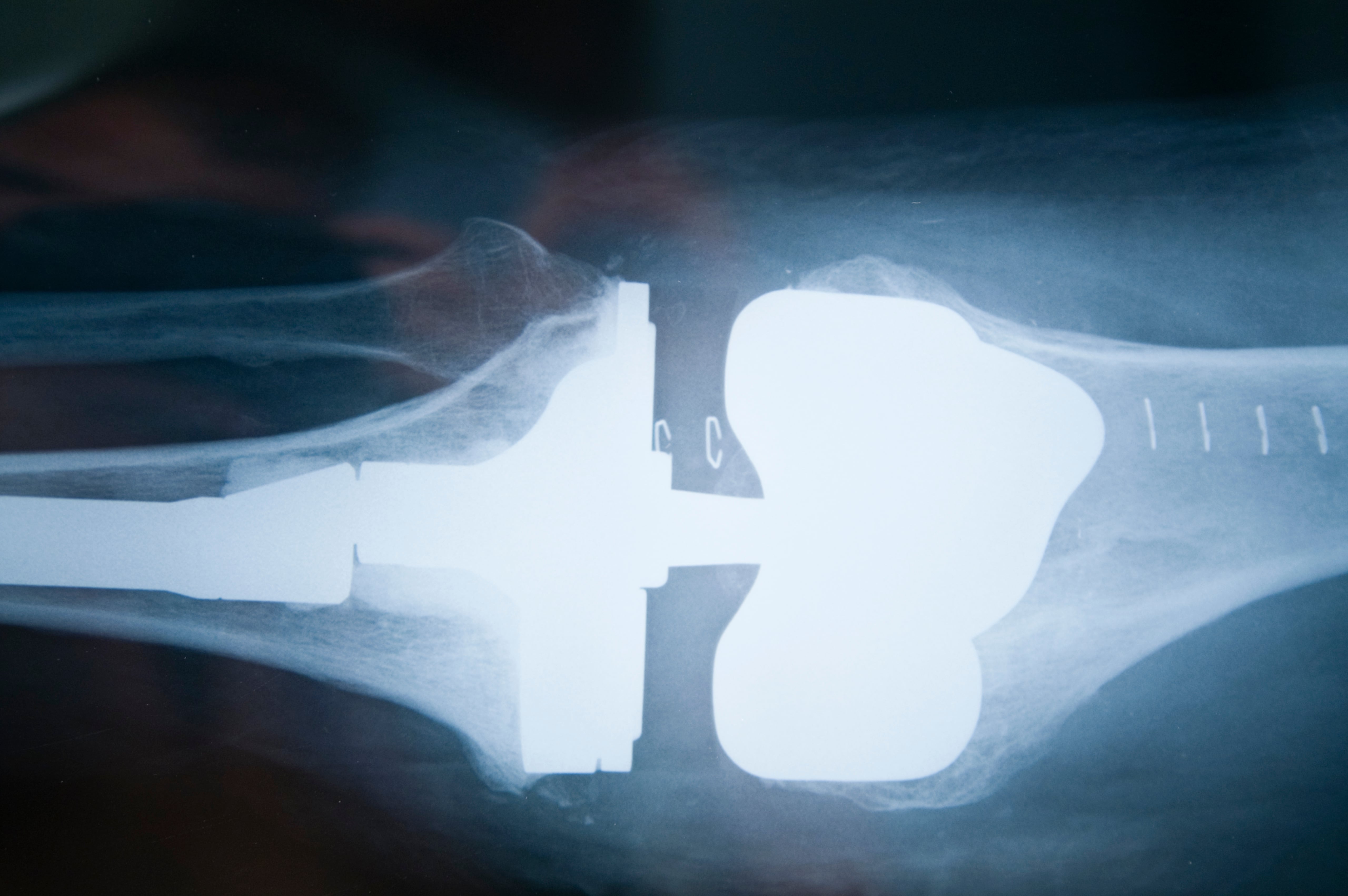 Prótesis en el codo (Artroplastia) | IOTAM